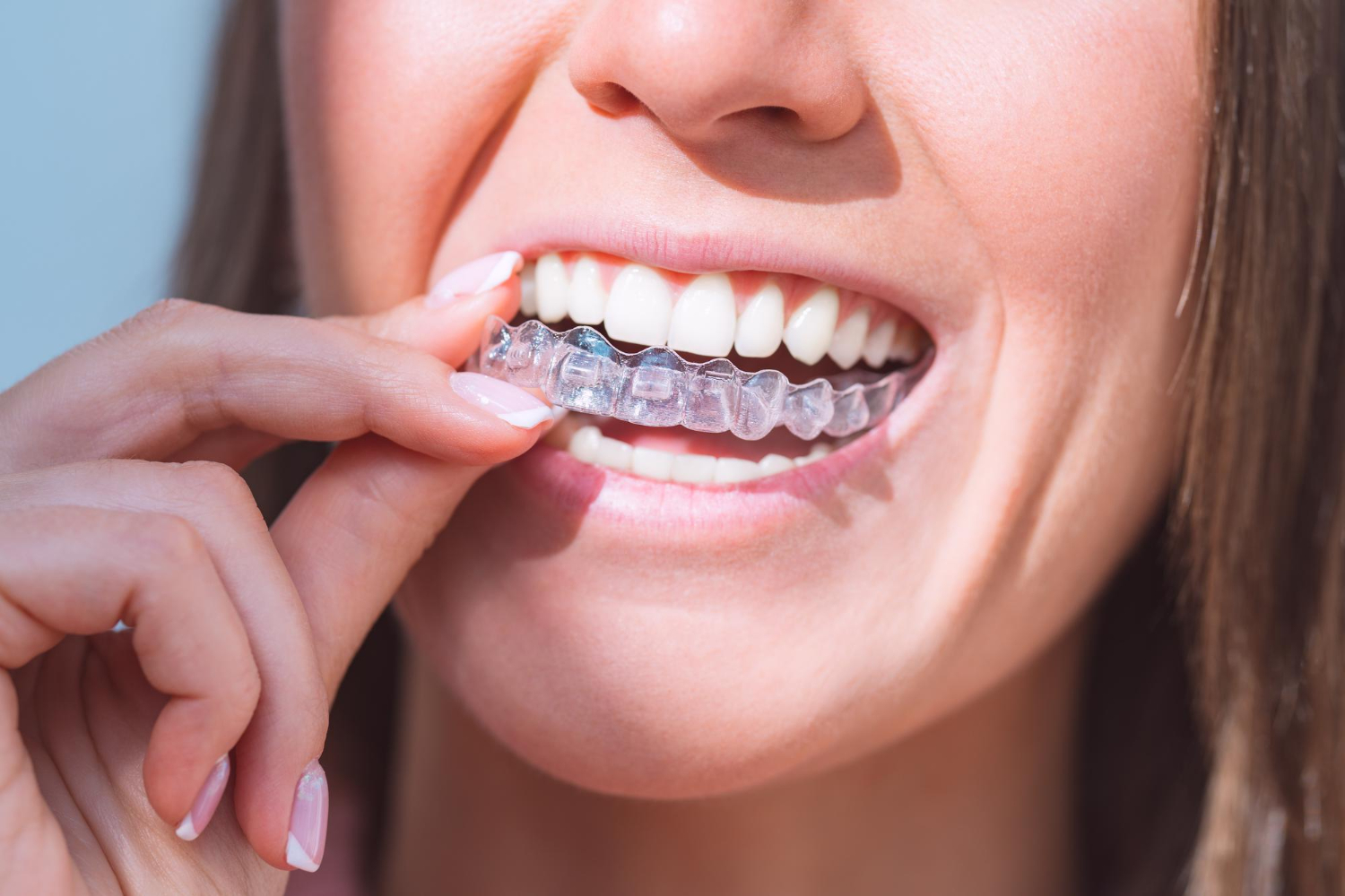 Unveiling the Perfect Smile with Invisalign and Clear Aligners