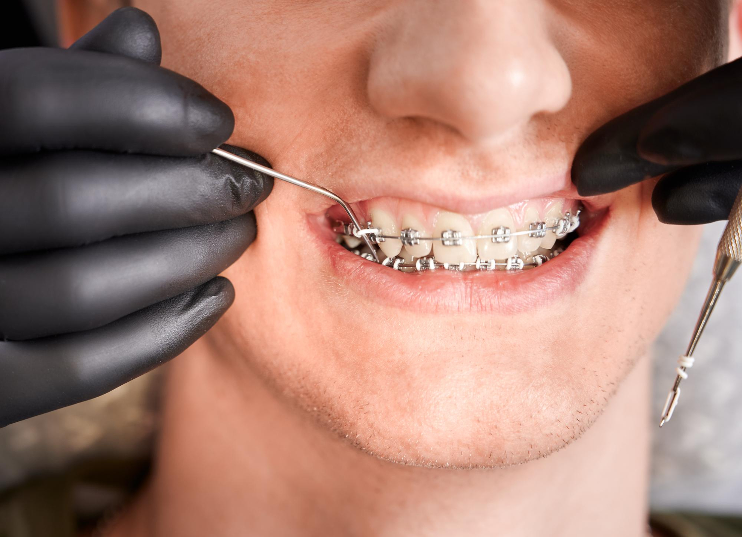 Adult Orthodontic Options, Benefits, and Airway Health